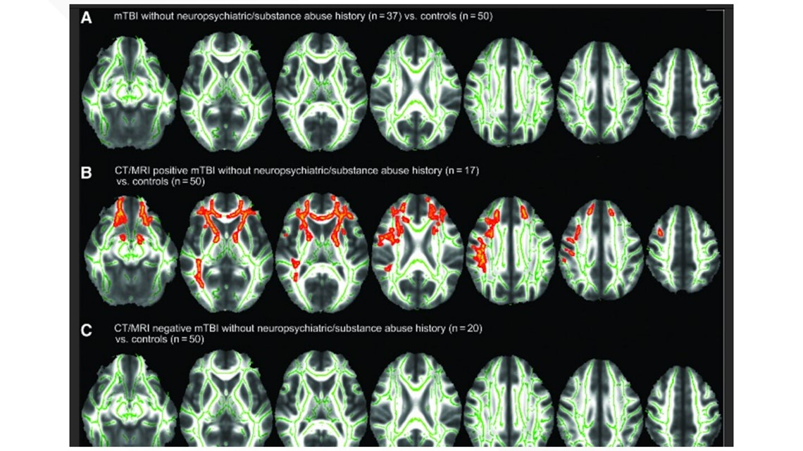 UT researchers get FDA approval for first lab test for TBI in US ...