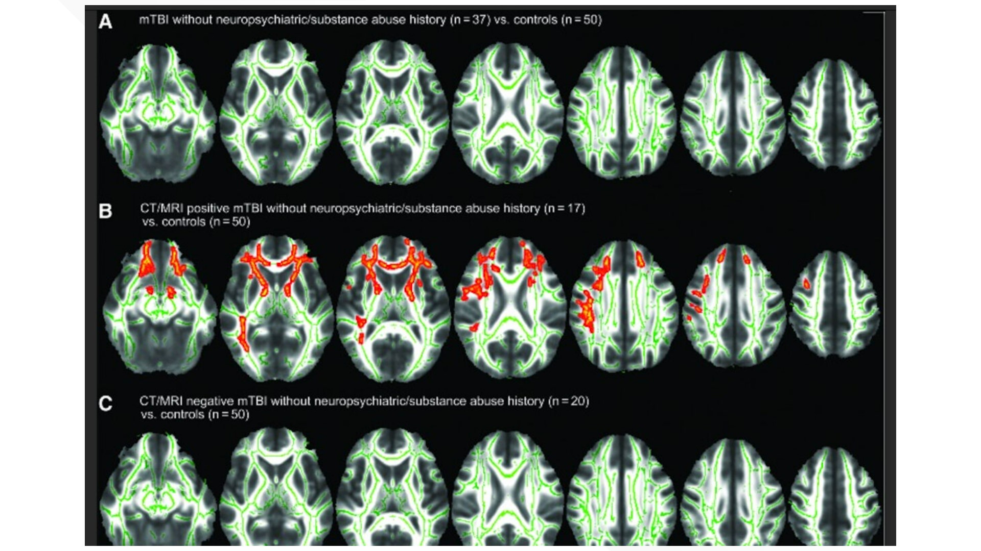 UT researchers get FDA approval for first lab test for TBI in US ...