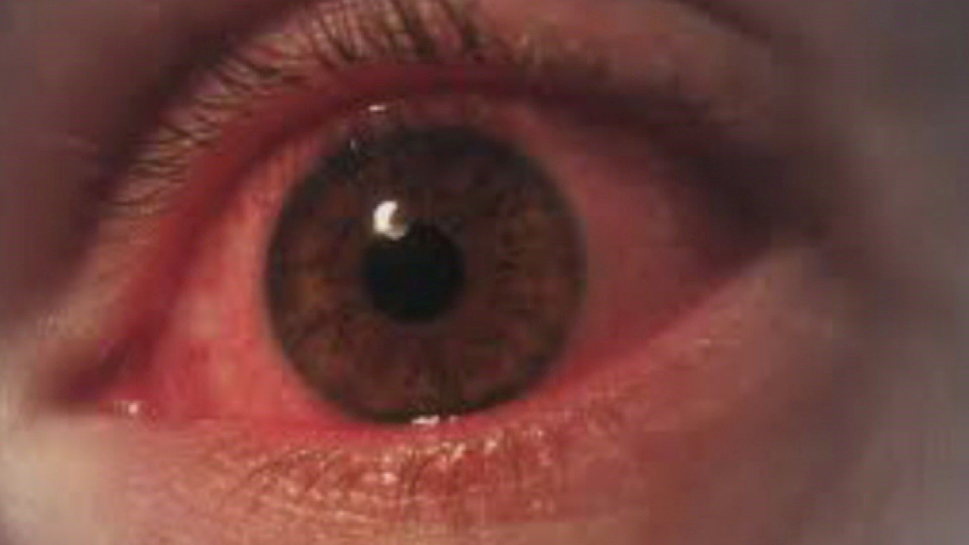 Extreme exposure to UV light can "sunburn" your eyes | newswest9.com